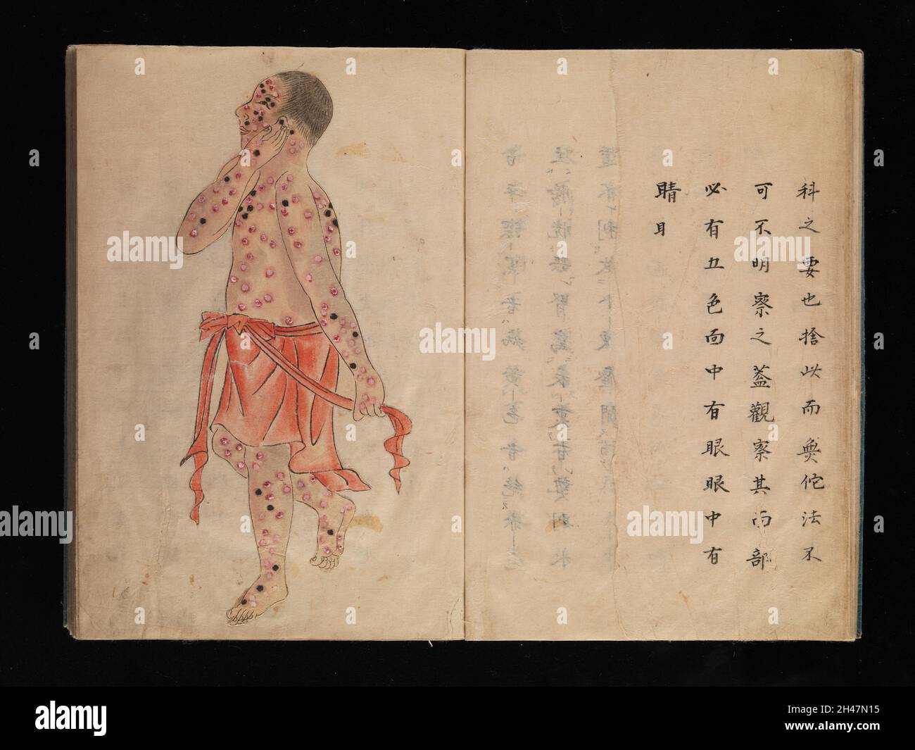 Smallpox illustration, Japanese manuscript, c. 1720 Stock Photo - Alamy