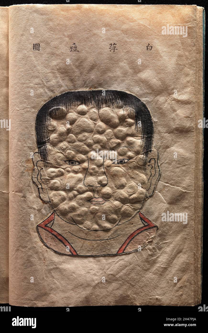 Smallpox, textured illustration, Japanese manuscript, c. 1720 Stock ...