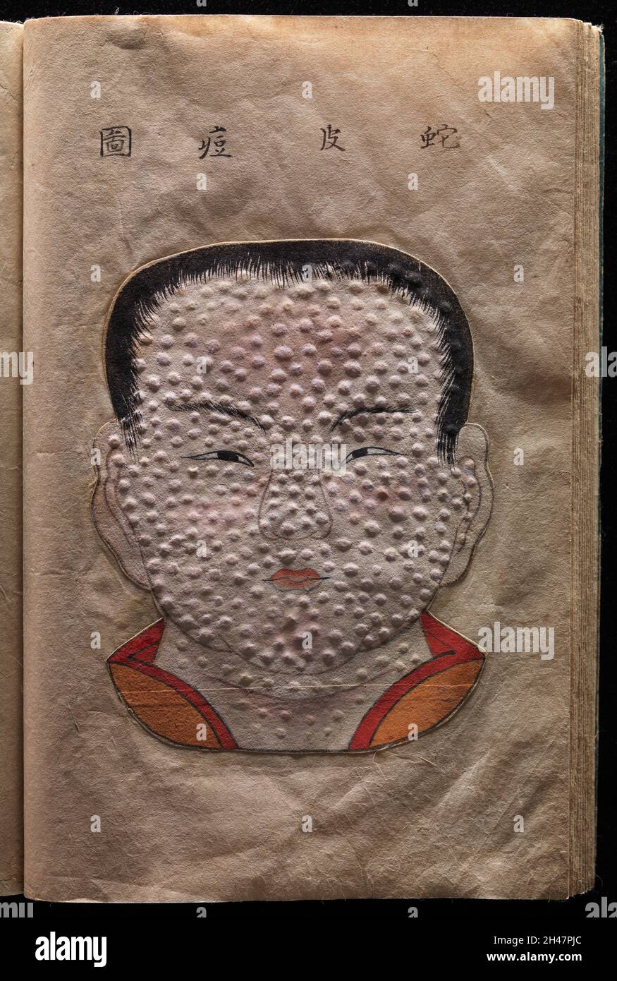 Smallpox, textured illustration, Japanese manuscript, c. 1720 Stock ...