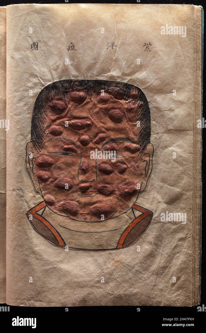 Smallpox, textured illustration, Japanese manuscript, c. 1720 Stock ...