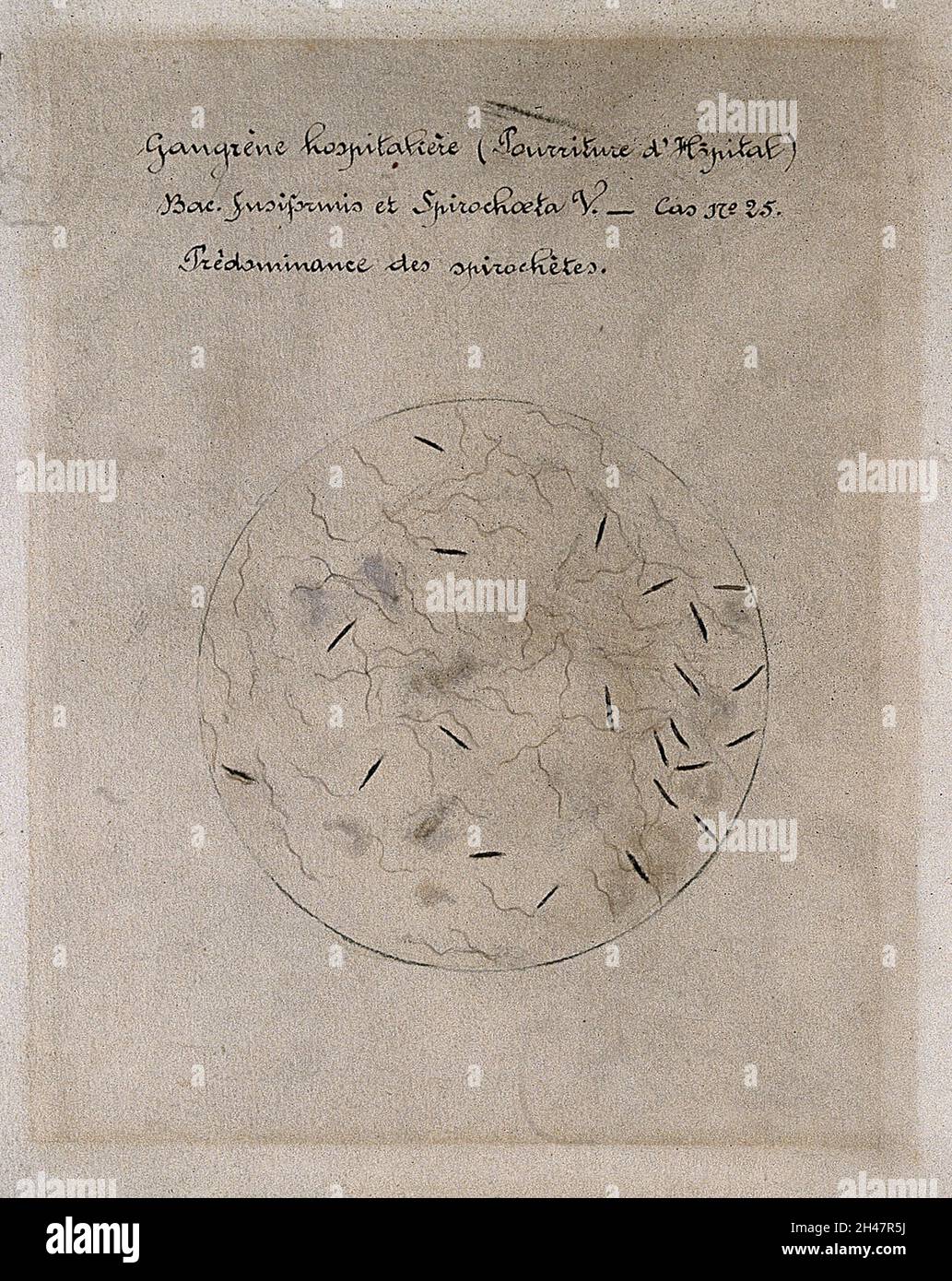 Hospital gangrene, fusiform bacillus and spirochetes. Drawing by H ...