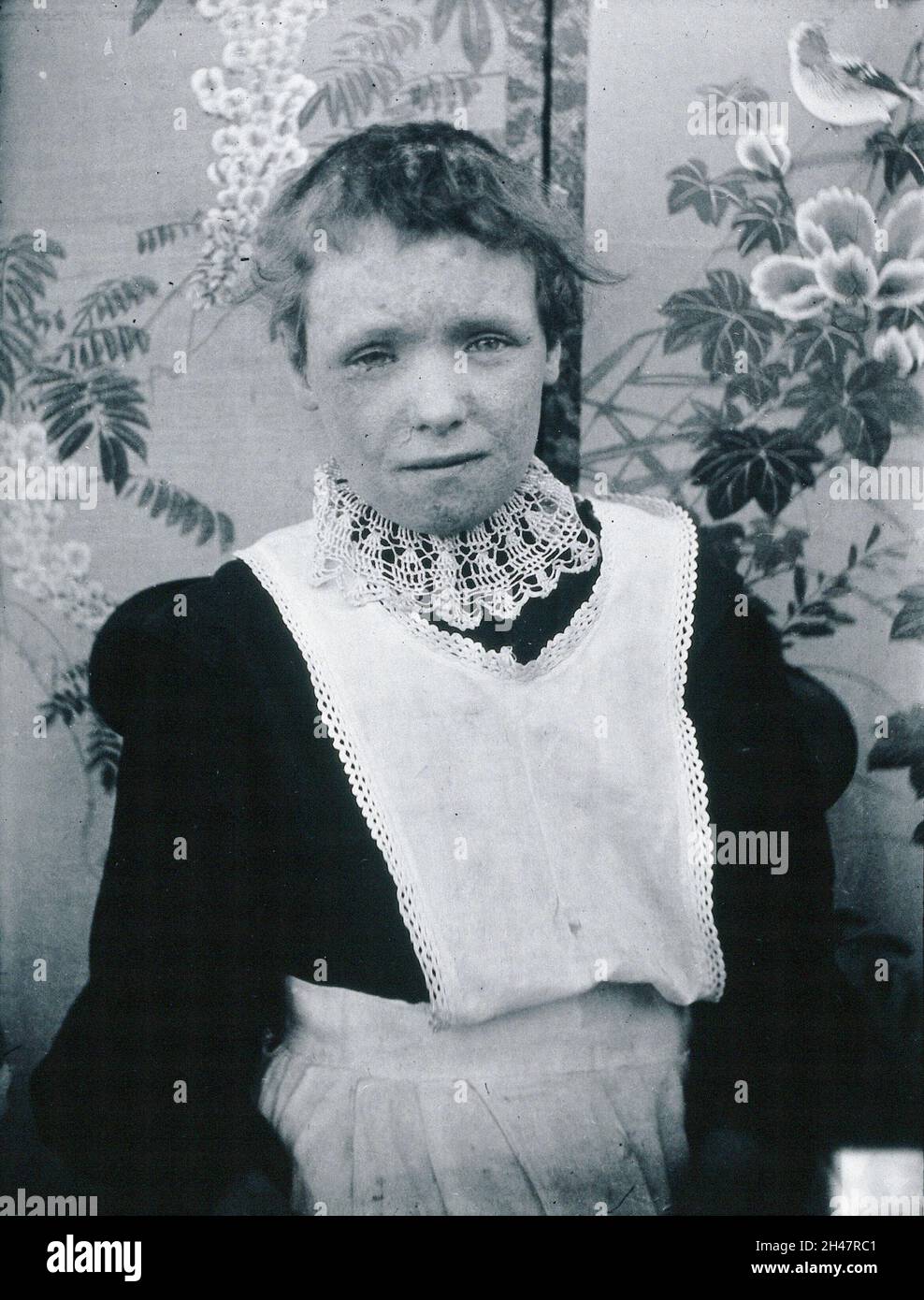 Gloucester smallpox epidemic, 1896: Kate Mills, a smallpox patient ...