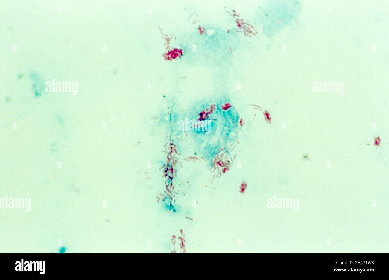 Leprosy: slit-skin smear test Stock Photo - Alamy