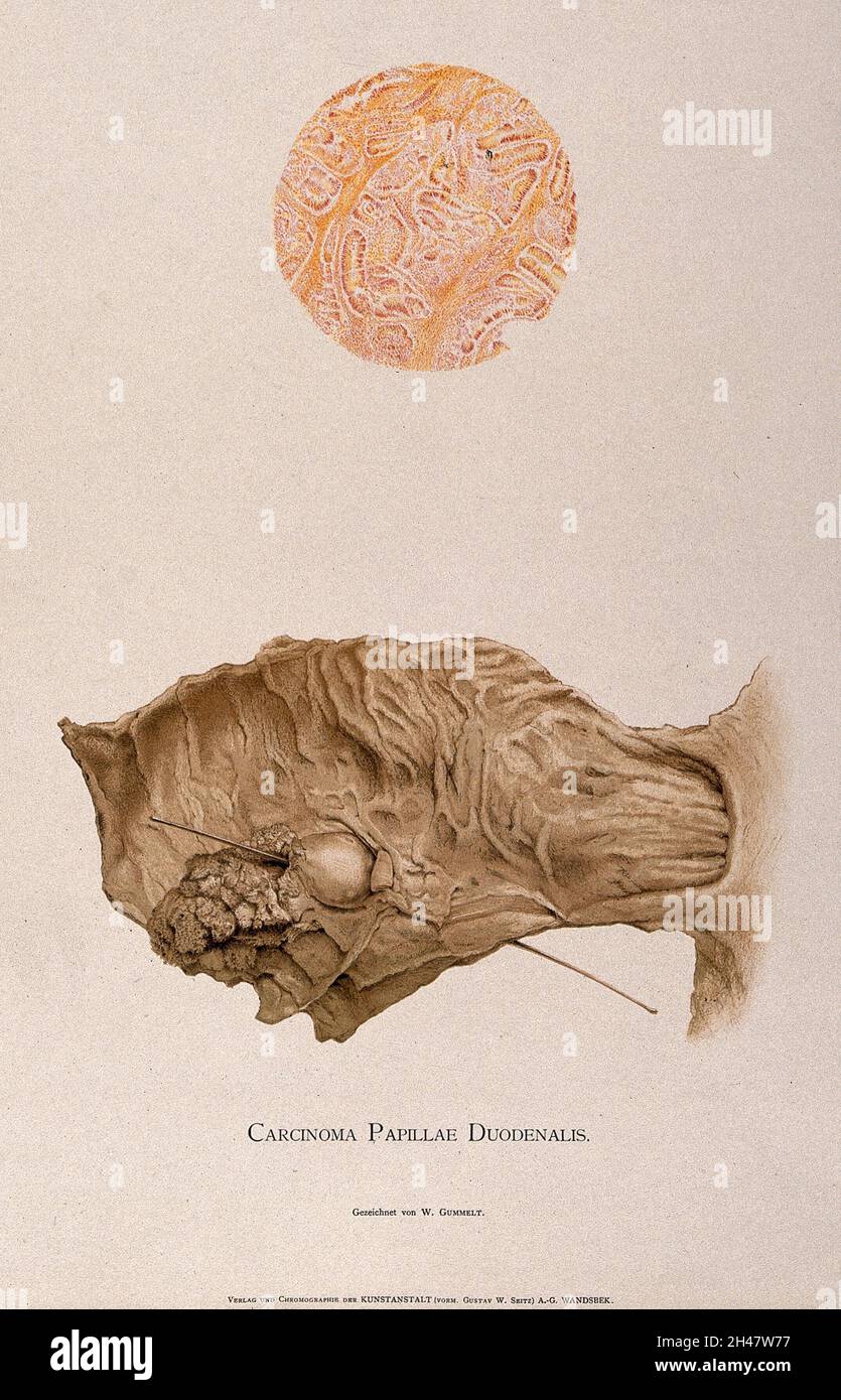 A diseased duodenum, with a detail showing cells as seen through a ...