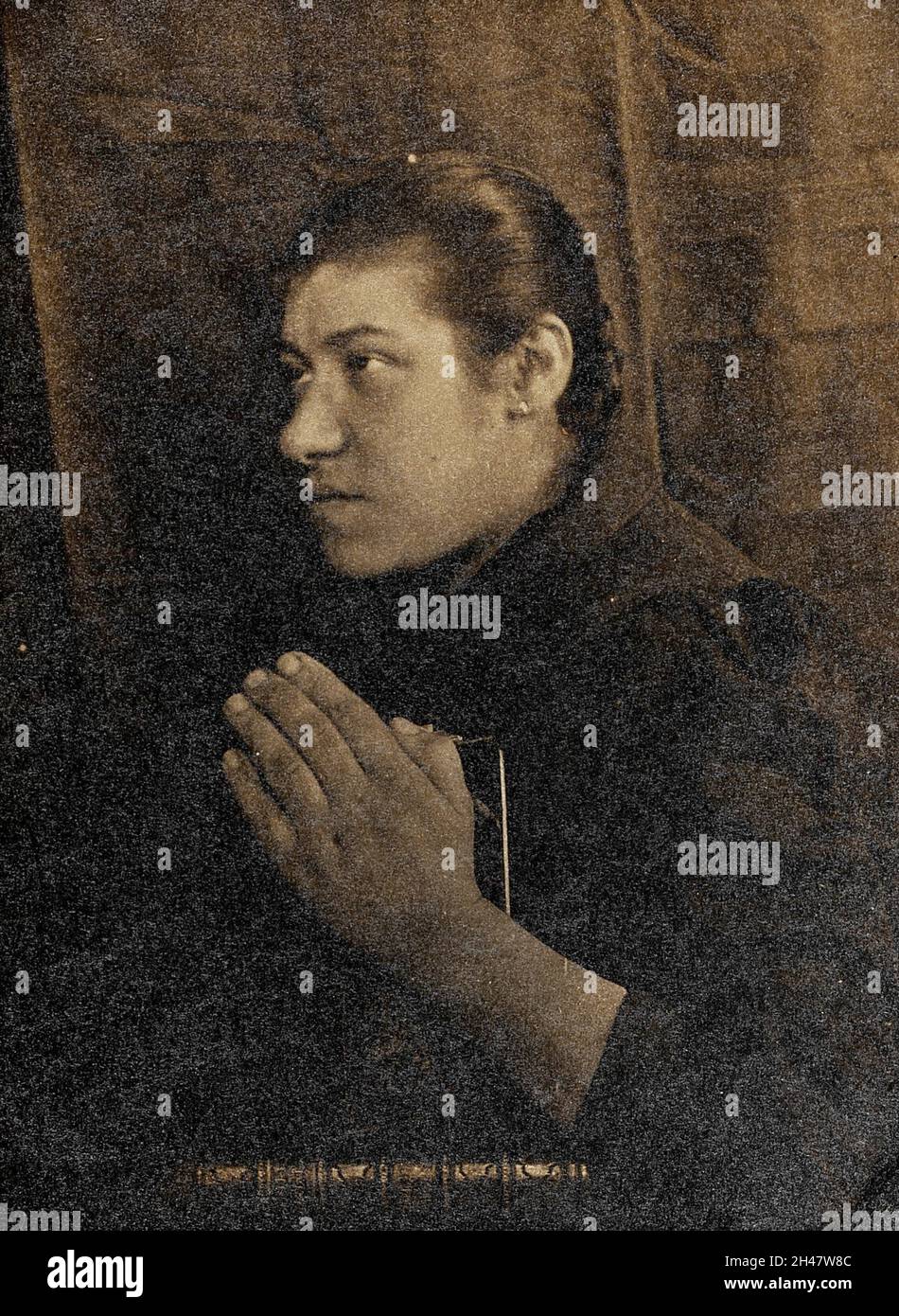 Acromegaly: a woman with enlarged hands due to a pituitary gland ...