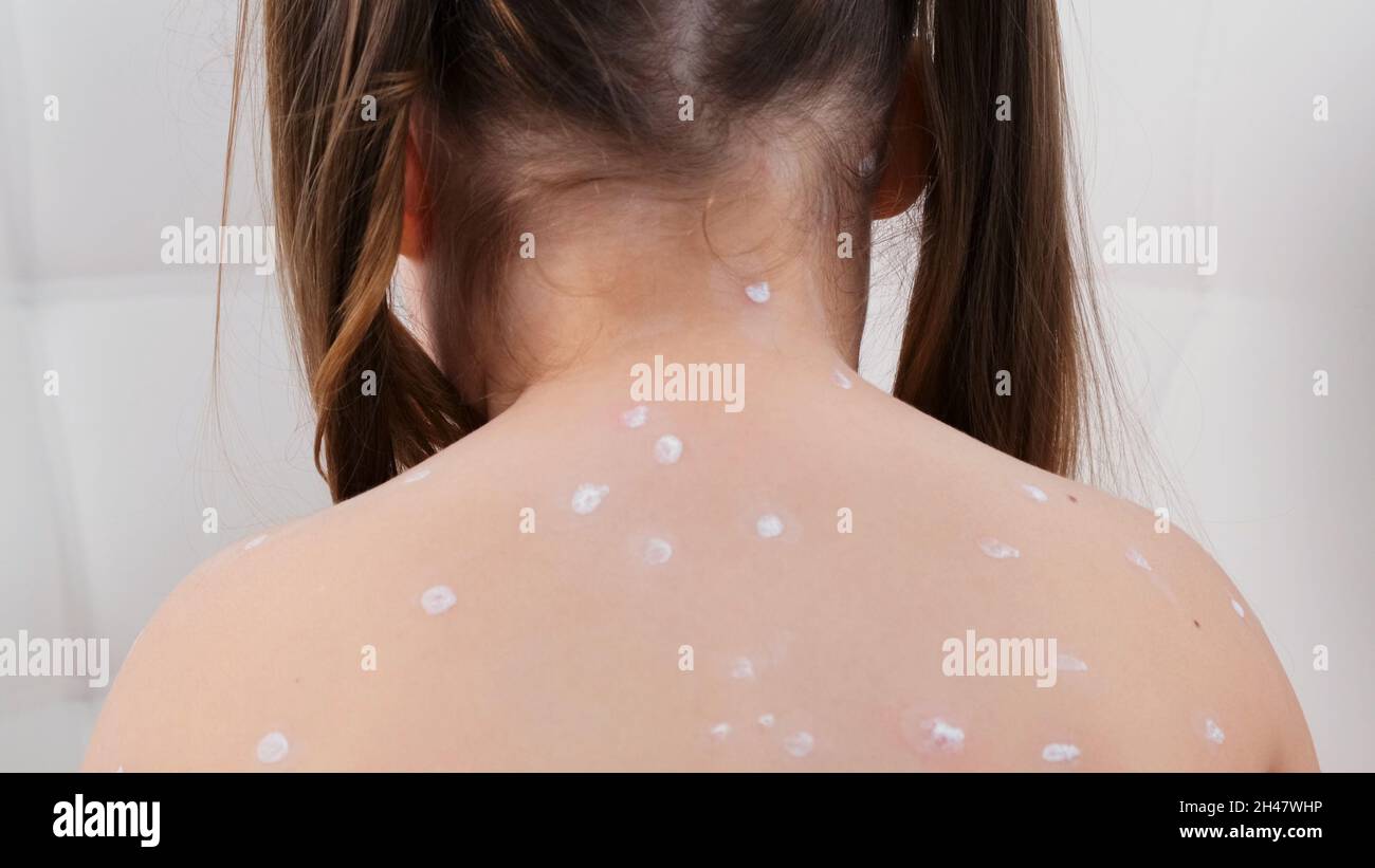 back girl with chickenpox, antiseptic cream applied to the rash. Rash ...