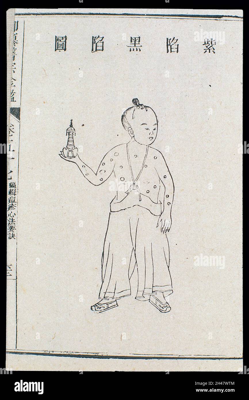 Chinese C18: Paediatric pox - 'Purple and black indentations' Stock ...