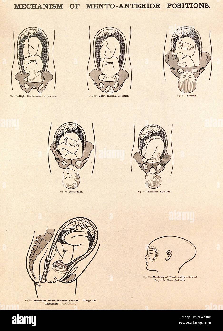 Mechanism of mento-anterior positions in childbirth. Lithograph after W ...