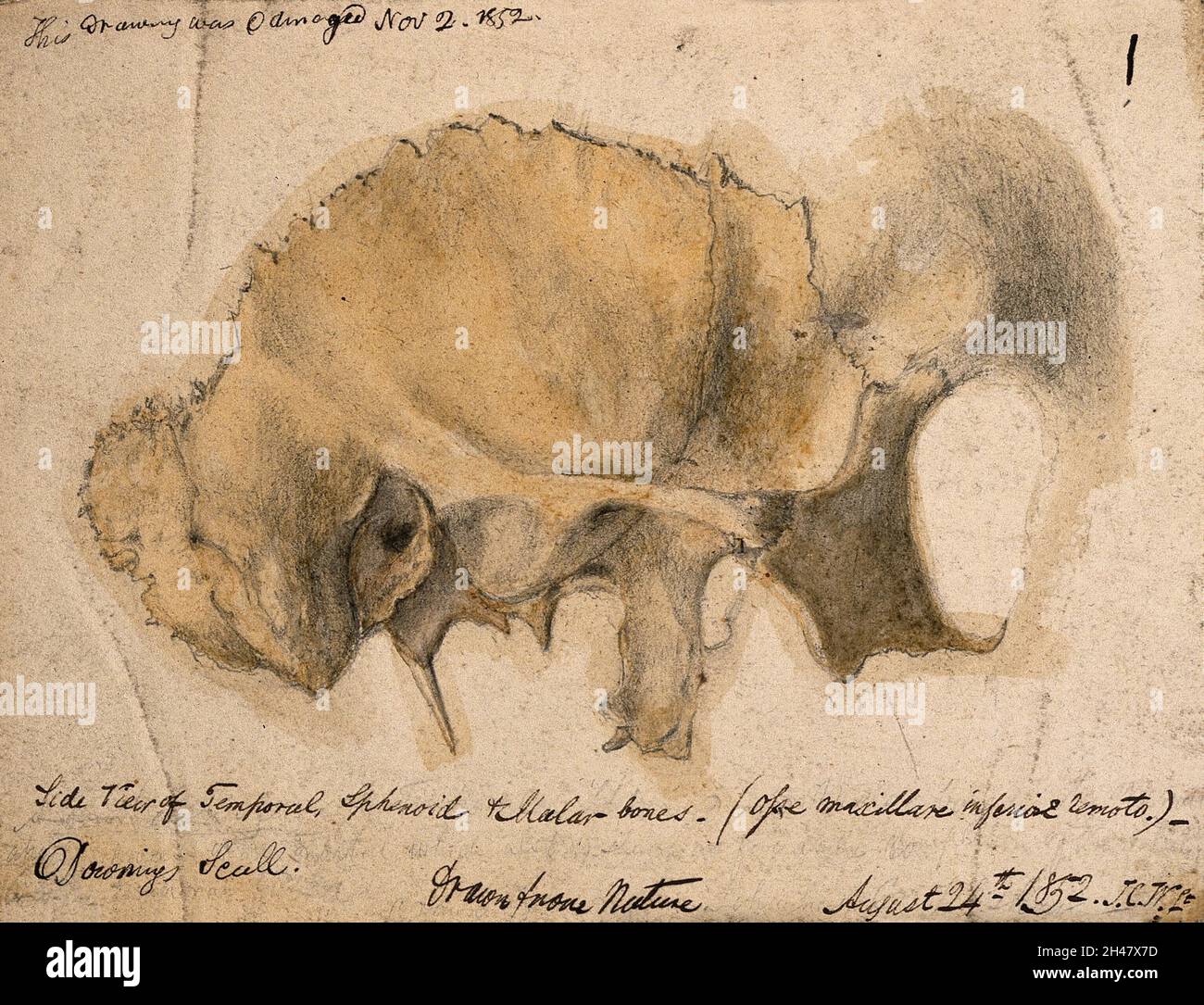 Bones of the cheek: side view of the temporal, schenoid and malar bones ...