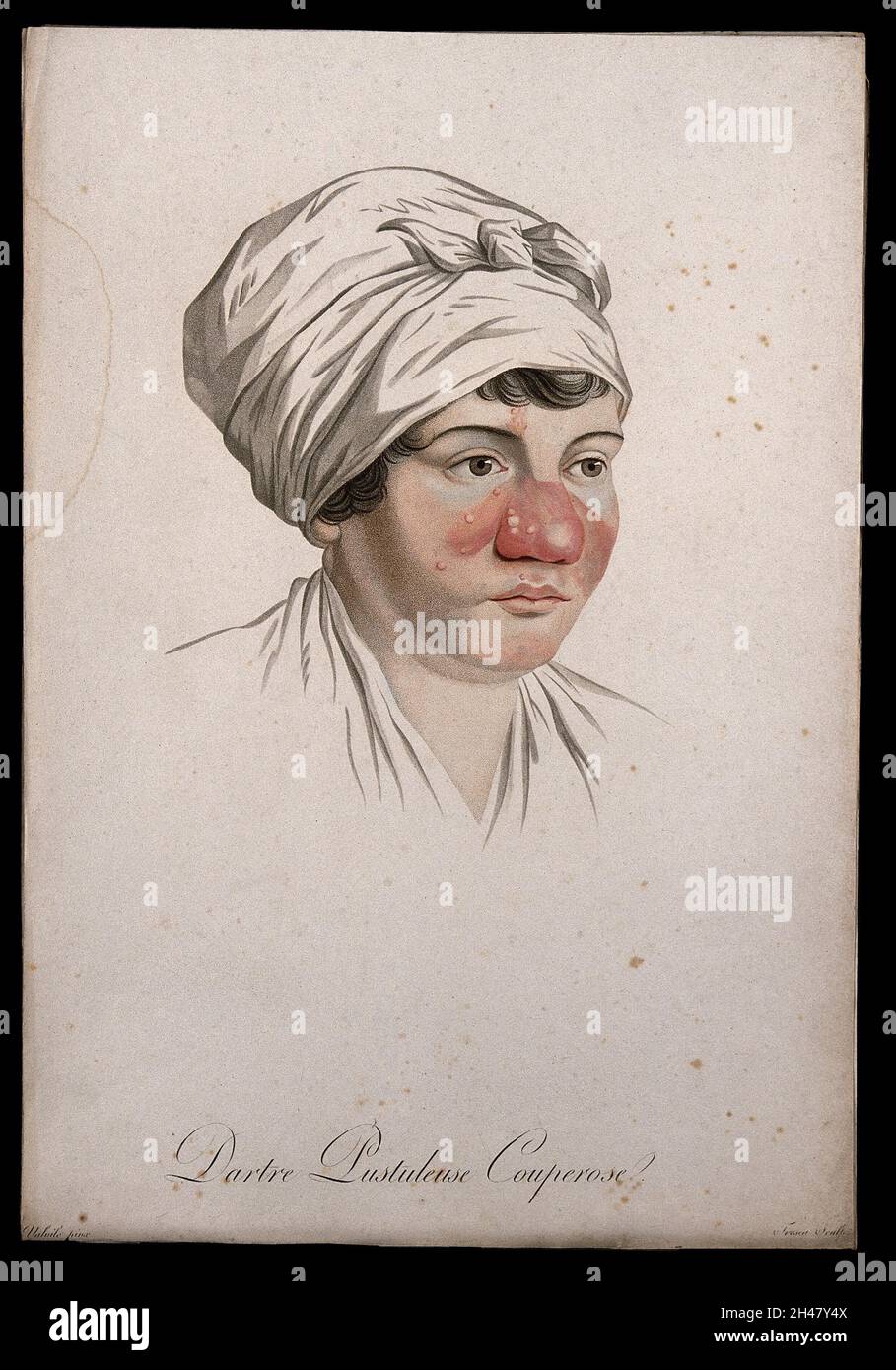 Head of a woman with a skin disease on her nose. Coloured stipple ...