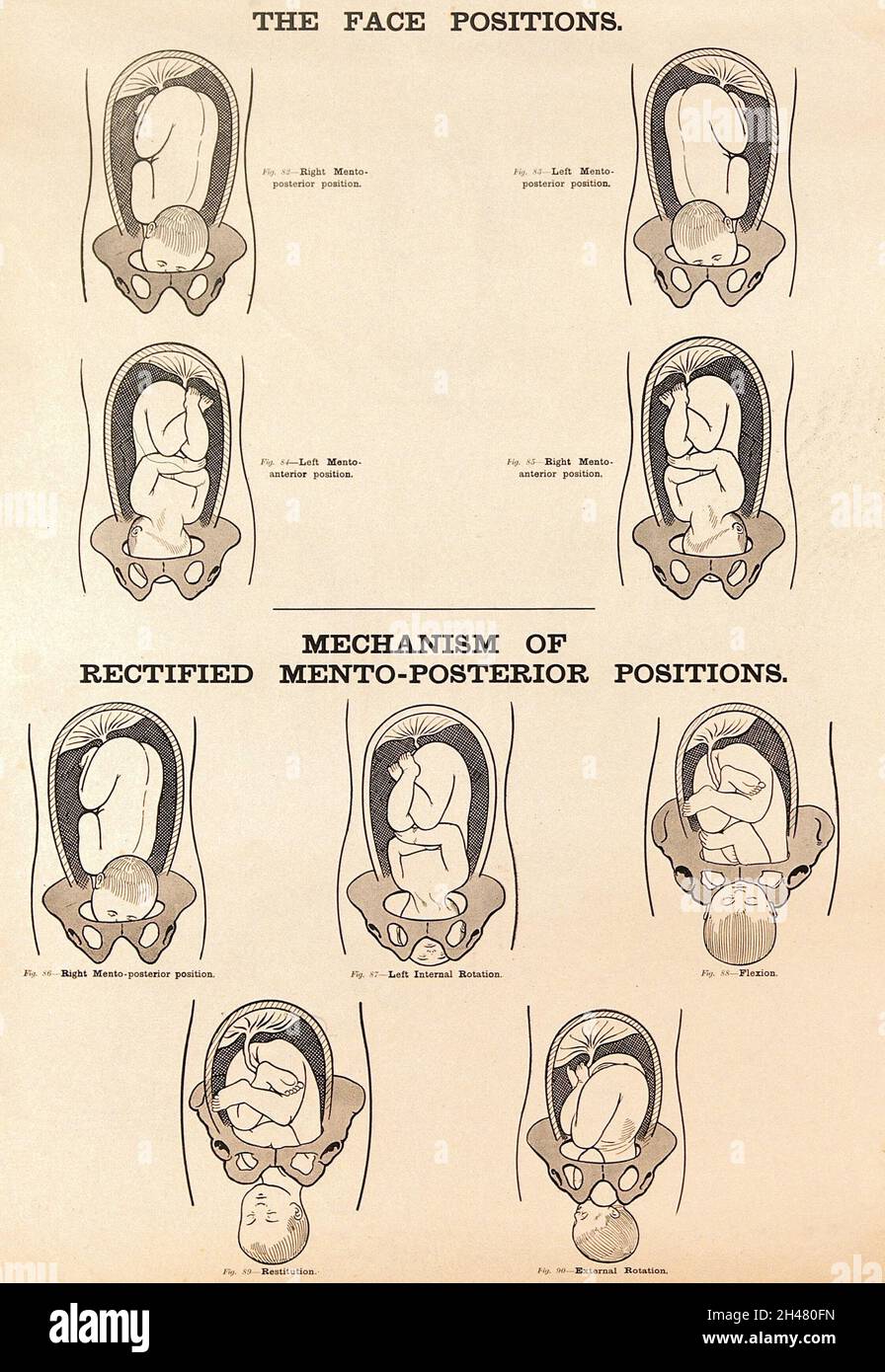 The face positions and the mechanism of rectified mento-posterior ...