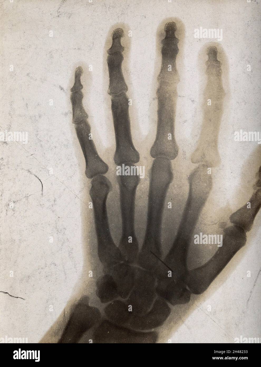 The bones of a hand, viewed through x-ray. Photoprint from radiograph ...