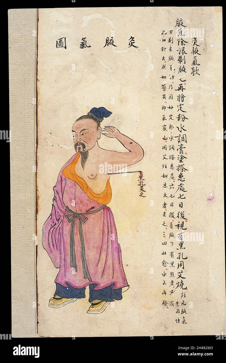 C19 Chinese MS moxibustion point chart: Underarm odour point Stock ...