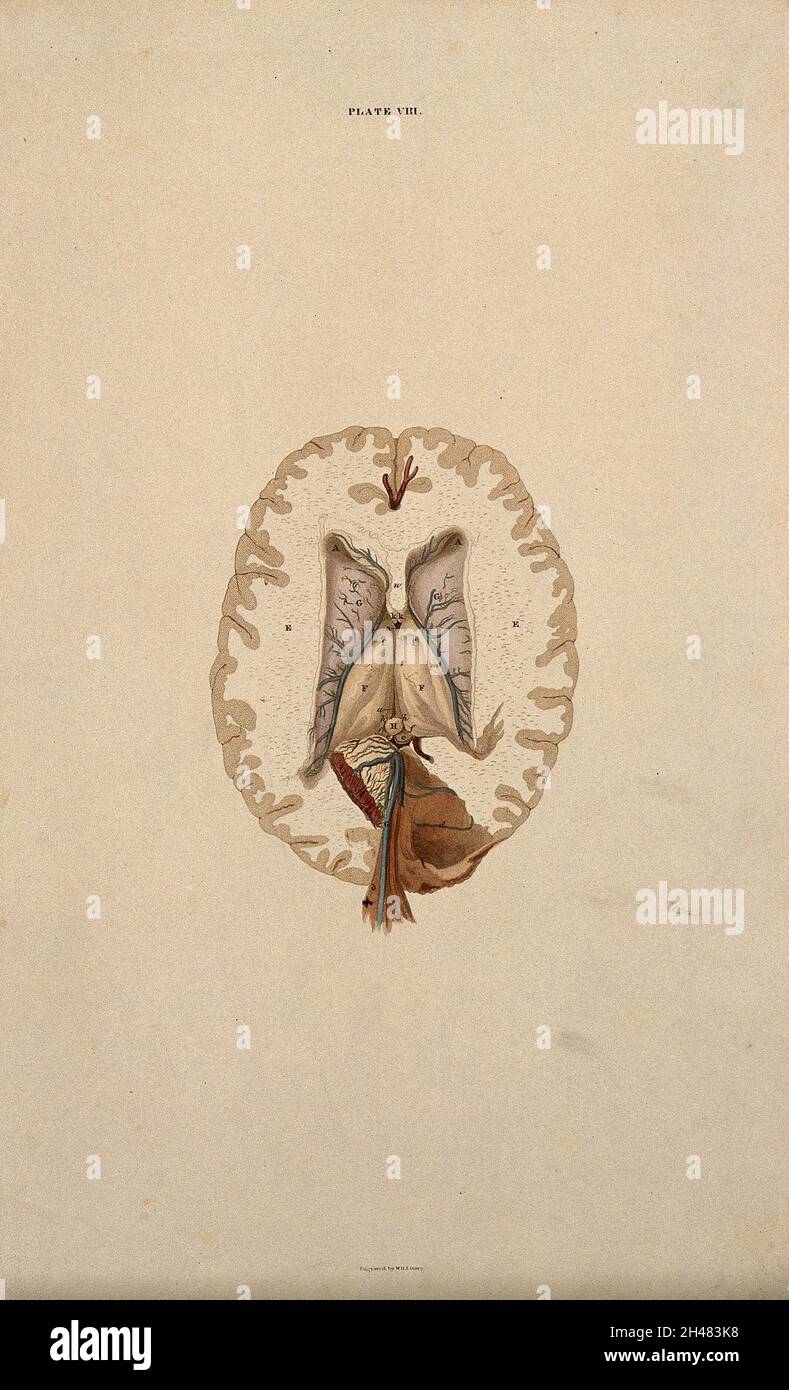 Brain: dissection showing the lateral ventricles and mid-brain ...