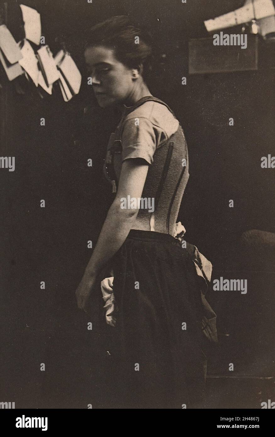 Woman with atrophy of the spinal muscles, after treatment with a jacket ...