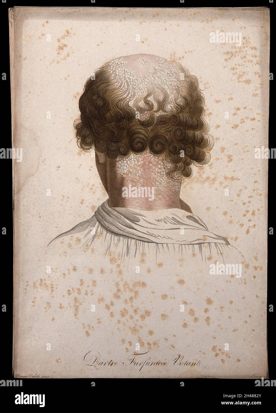 Head of a man with skin disease; back view. Coloured stipple engraving ...