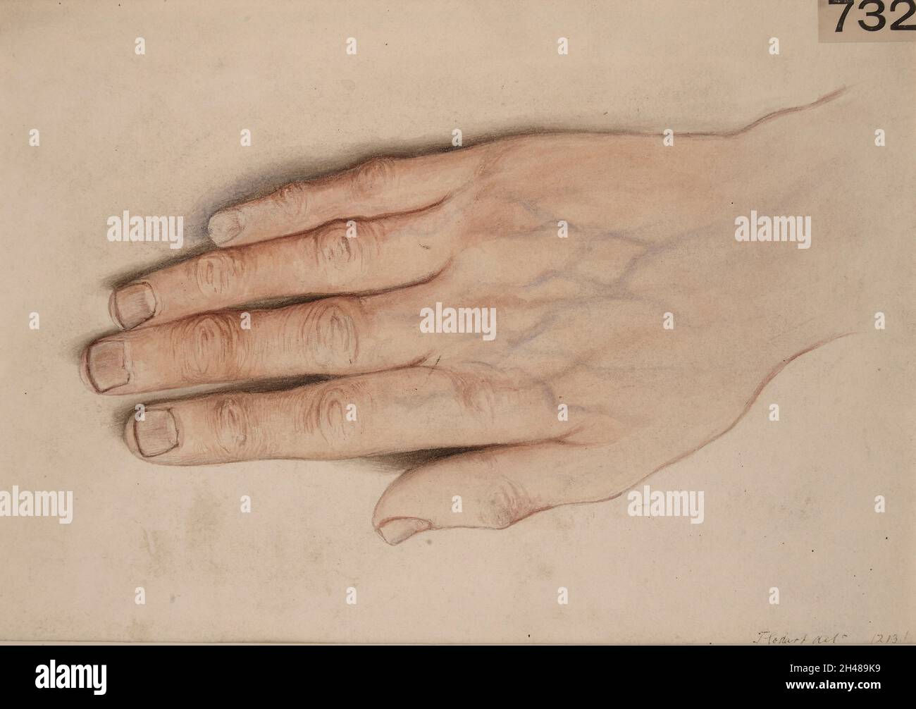 Unaffected right hand of a patient whose left median nerve was divided ...