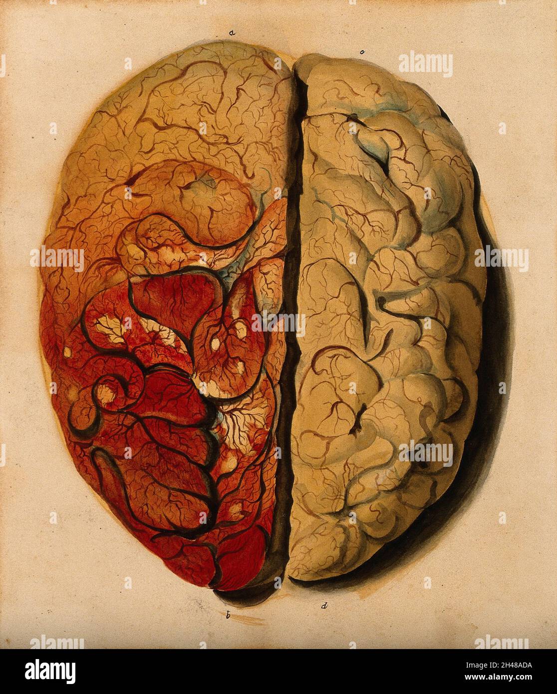 Pia mater hi-res stock photography and images - Alamy