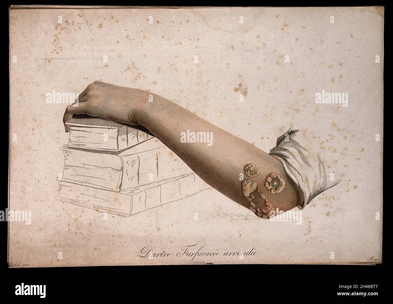 A forearm with a skin disease on the elbow. Coloured stipple engraving ...