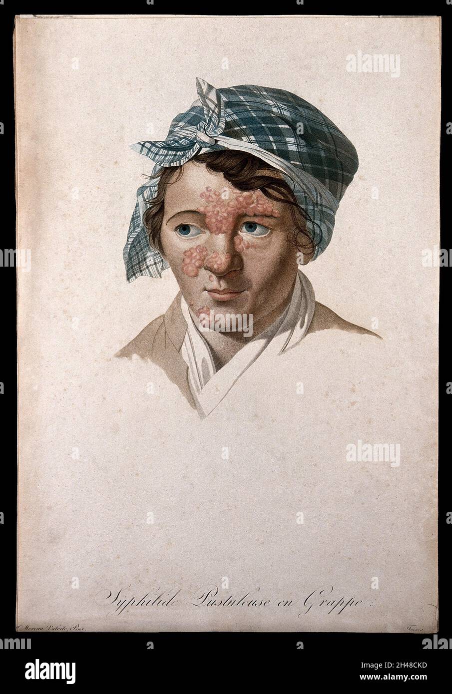 A woman with a skin disease on her face. Coloured stipple engraving by ...