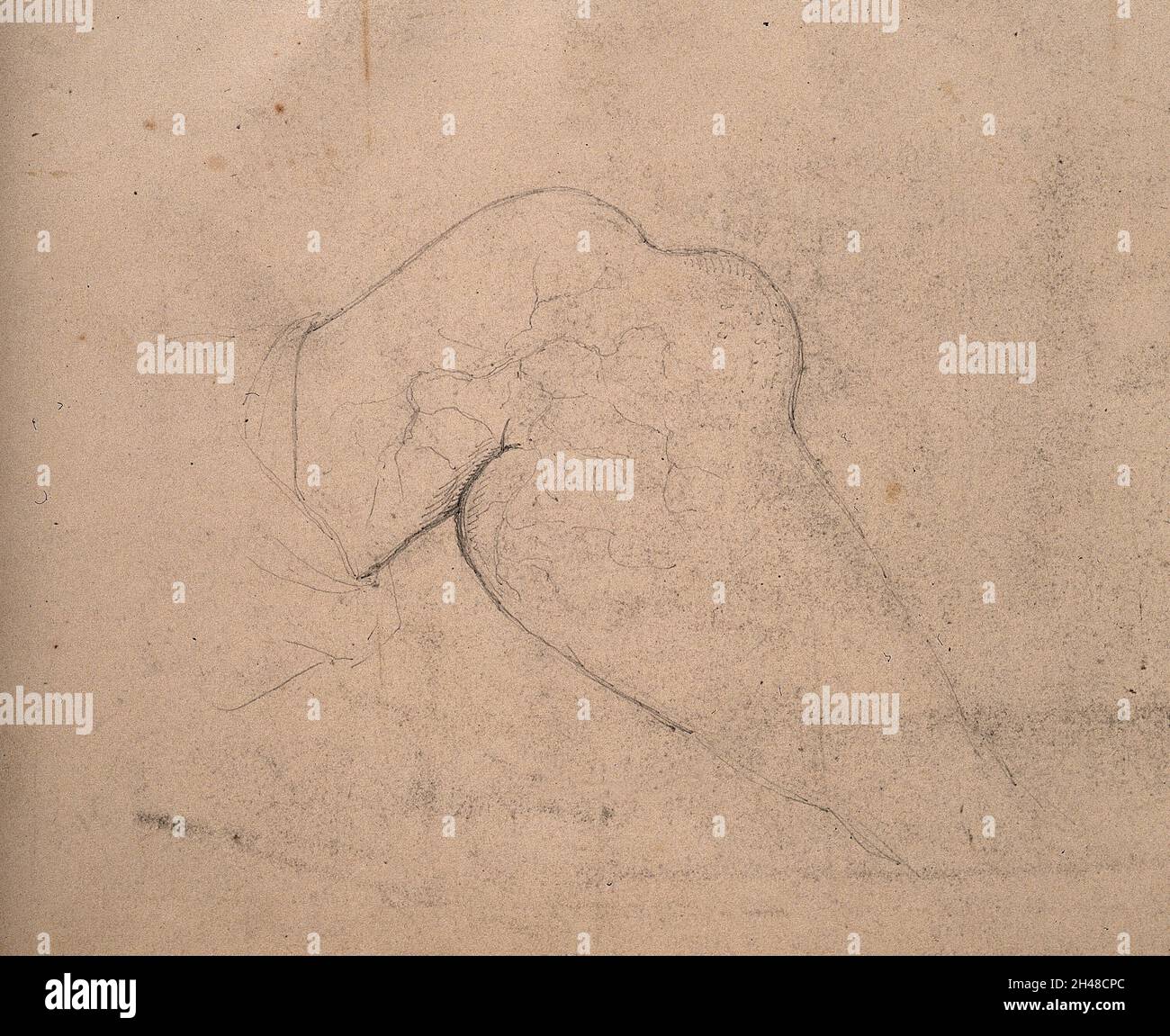 A deformed knee. Drawing Stock Photo - Alamy