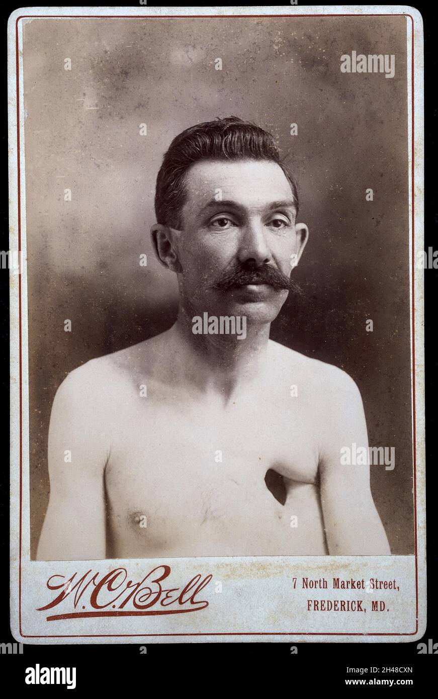 Reverend Eavens, a man with a hole in his chest. Albumen print by W.C ...
