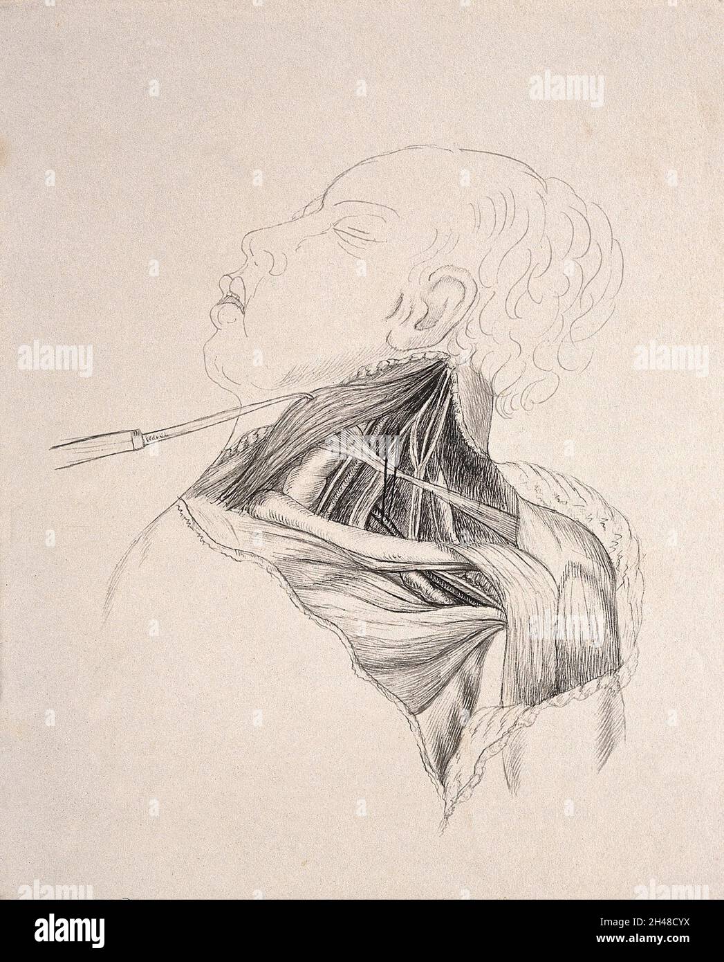 The dissected neck, chest and shoulder of a man: the skin being held ...