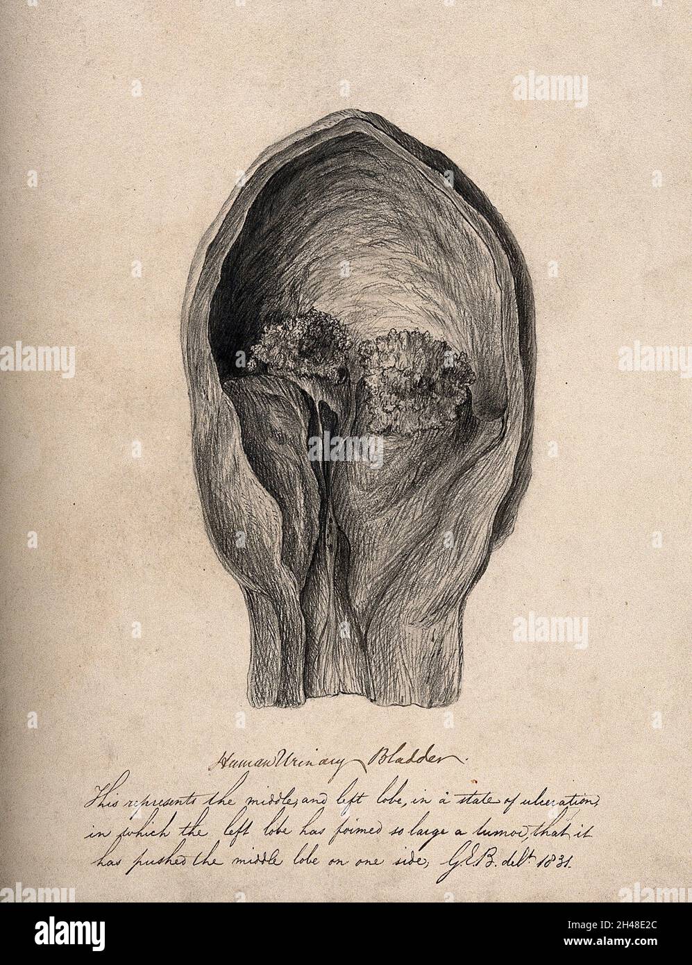 A human bladder with a tumour. Pencil drawing by G.E. Blenkins, 1831 ...