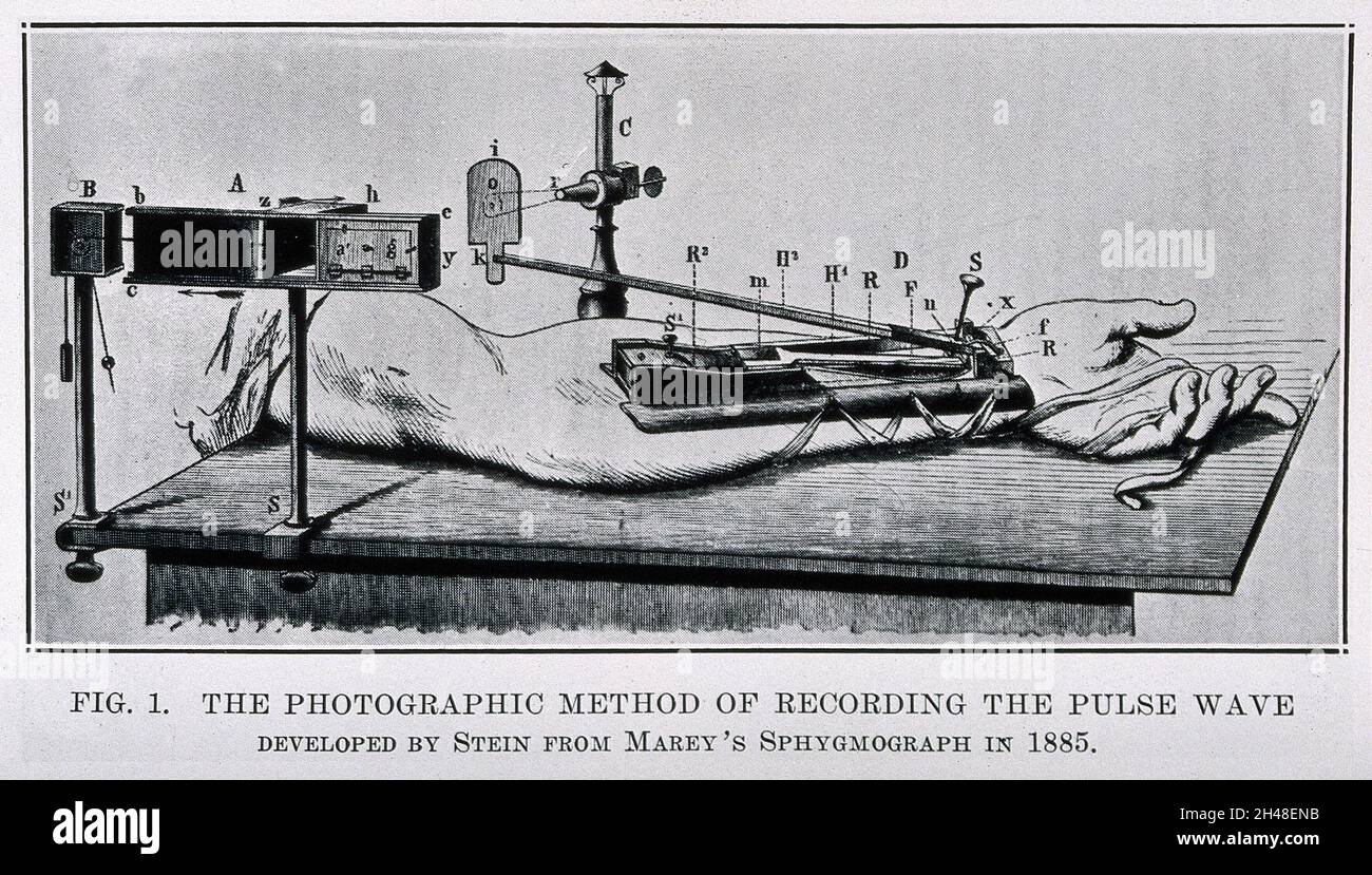 The photographic method of recording the pulse wave, by Stein, from ...