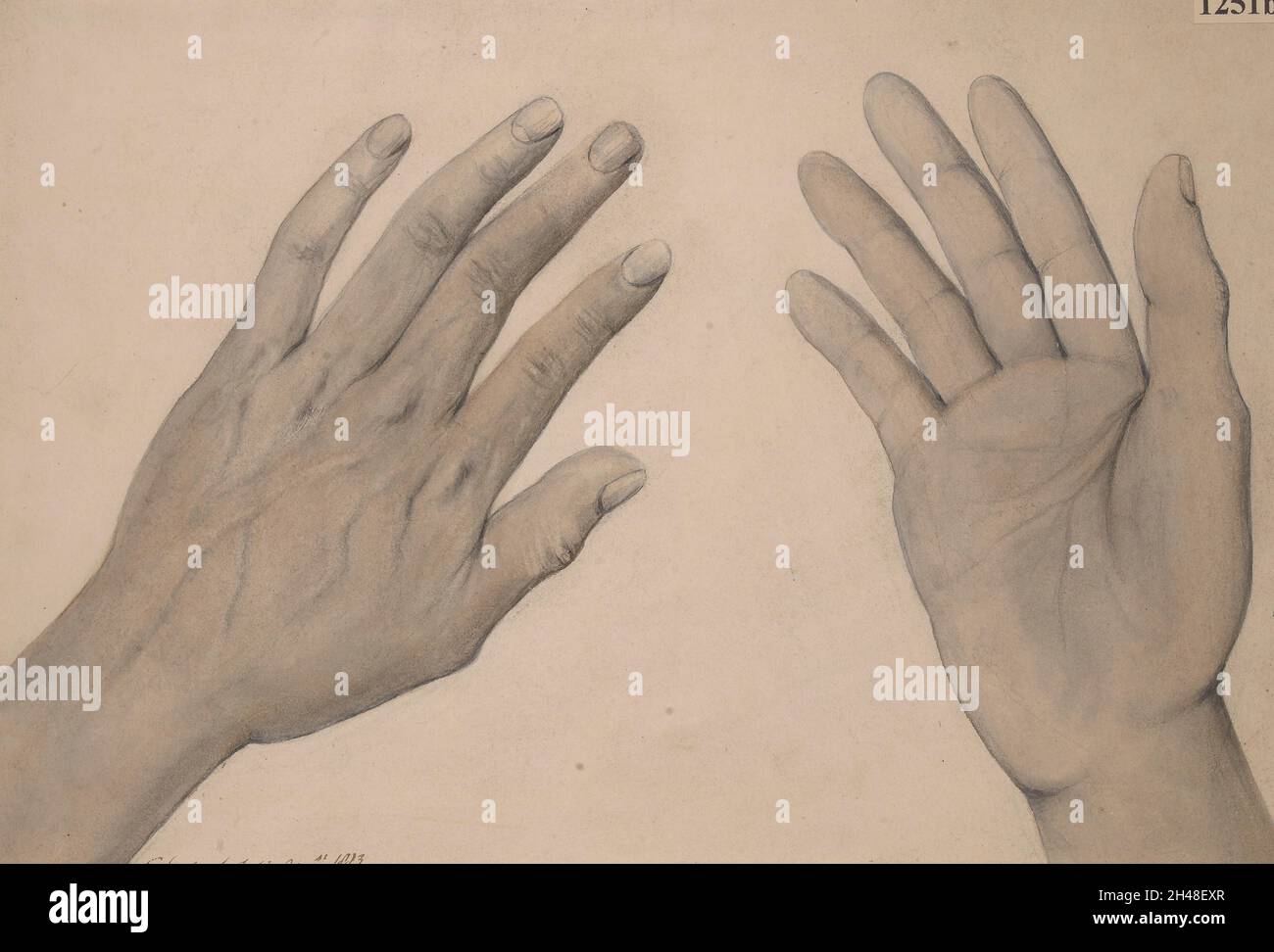 Hands of a man with peculiar staining of the skin, caused by melanotic ...