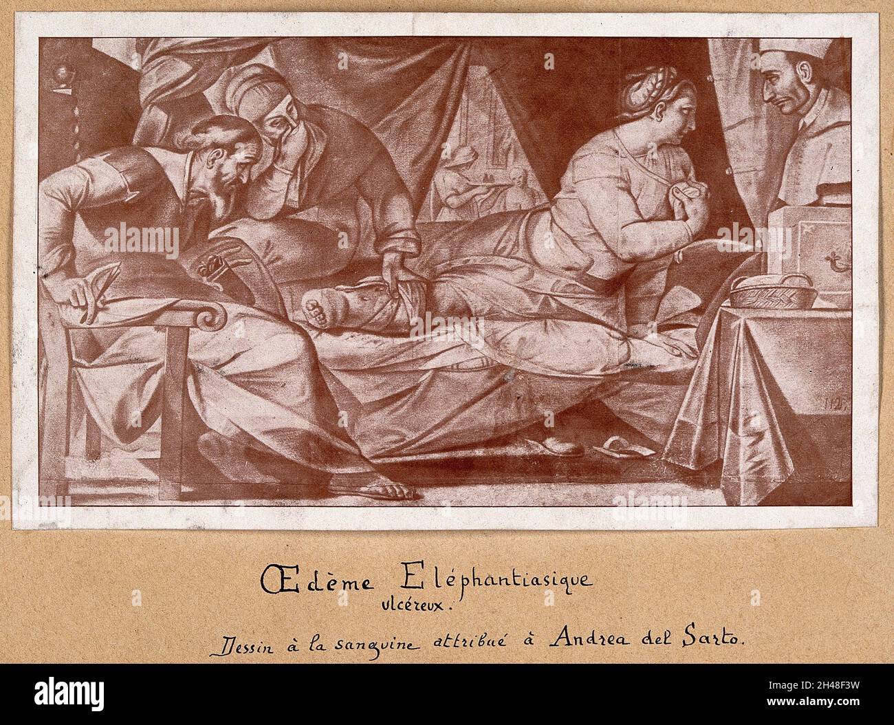 A woman suffering from elephantiasis, being examined by three people ...