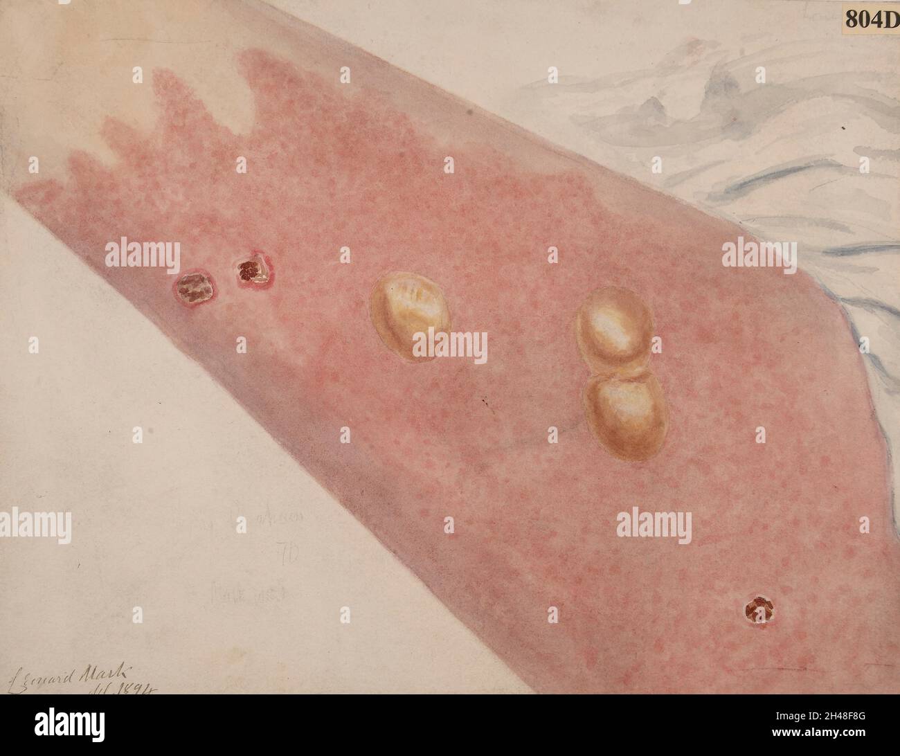 Bullous eruption occurring on the thigh, from a case of pemphigus Stock ...