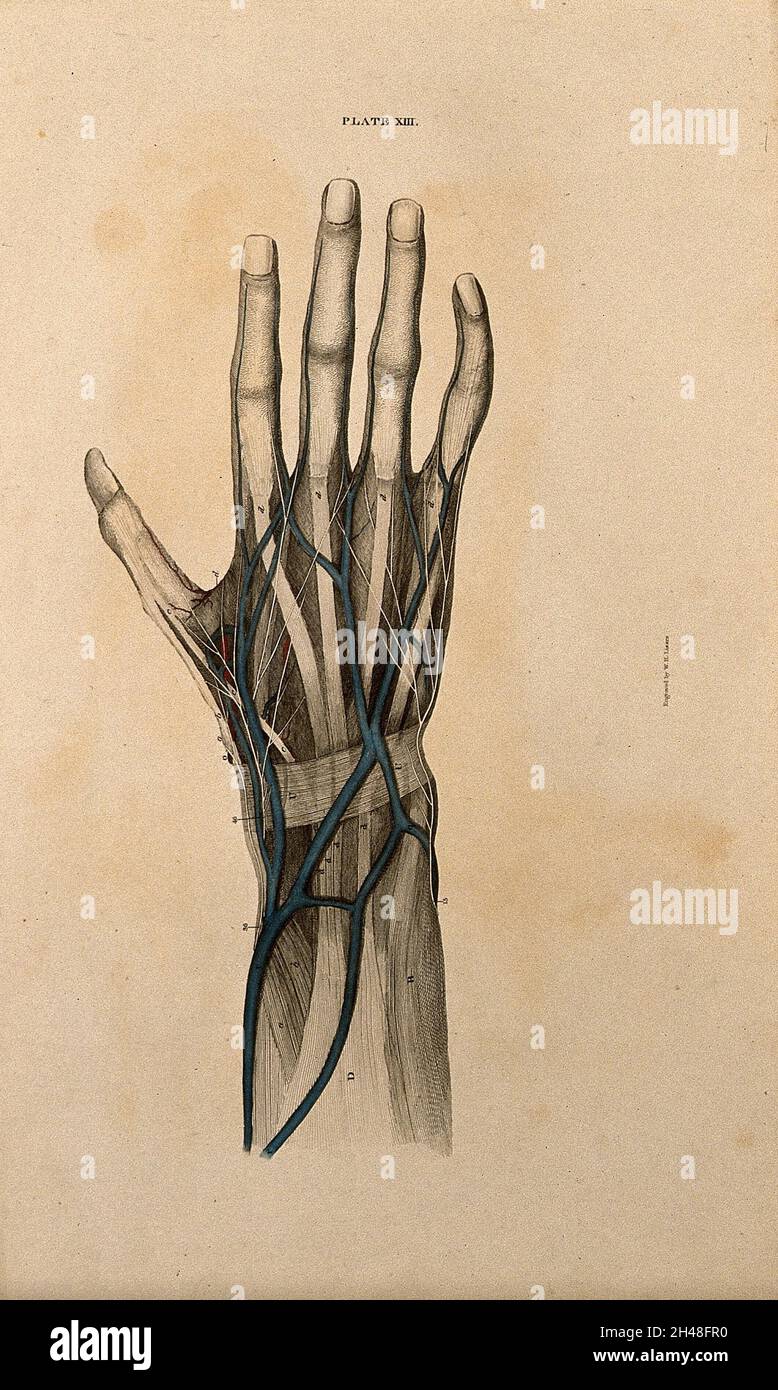 Hand: dissection, with blood vessels and nerves indicated in red and ...