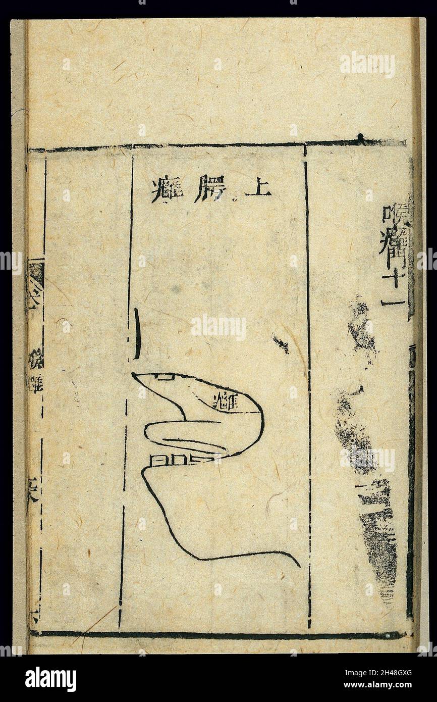 Chinese C19 woodcut: Abscesses on the palate Stock Photo - Alamy