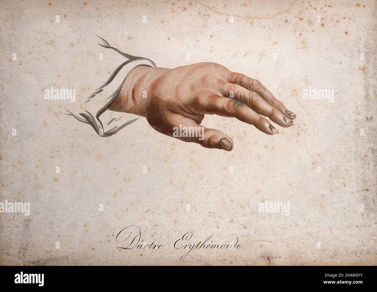 A hand with a skin disease. Coloured stipple engraving by S. Tresca ...