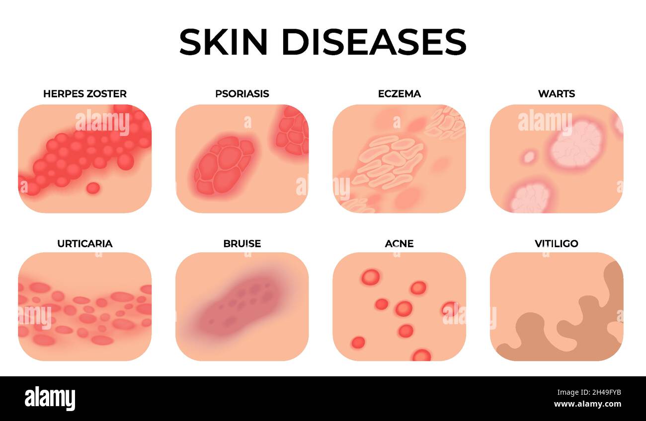 Eczema Herpes Zoster Stock Vector Images Alamy Eczema Herpes Zoster Stock Vector Images Alamy