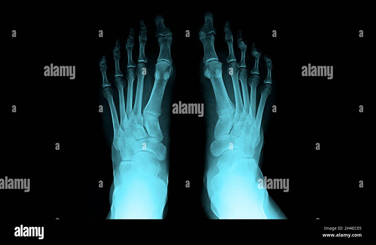 The Bend Of Leg And Foot X Ray