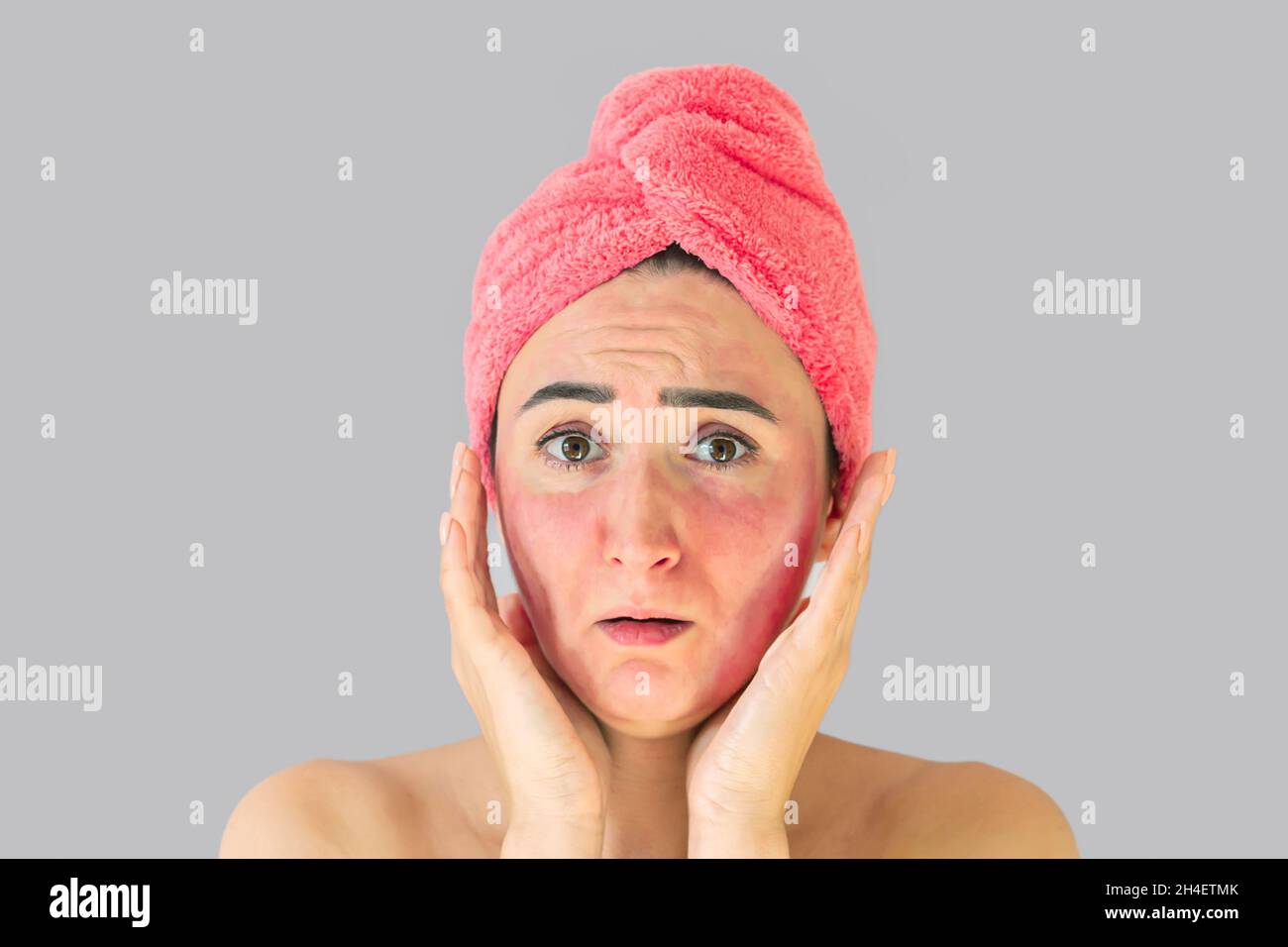 Sad face of young woman with skin irritation, redness, skin problems ...