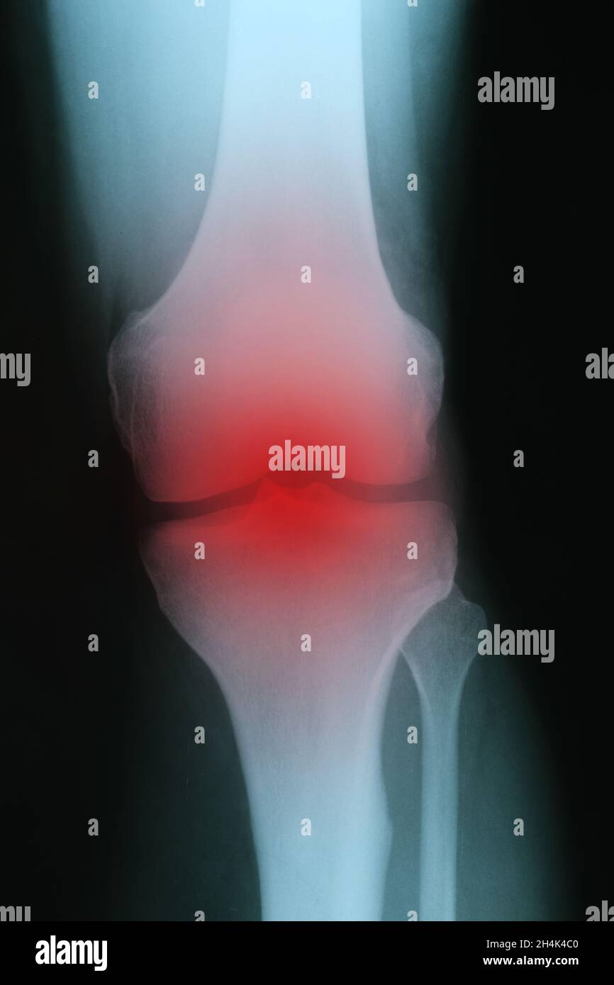 X ray with red inflammation of knee joint closeup Stock Photo - Alamy
