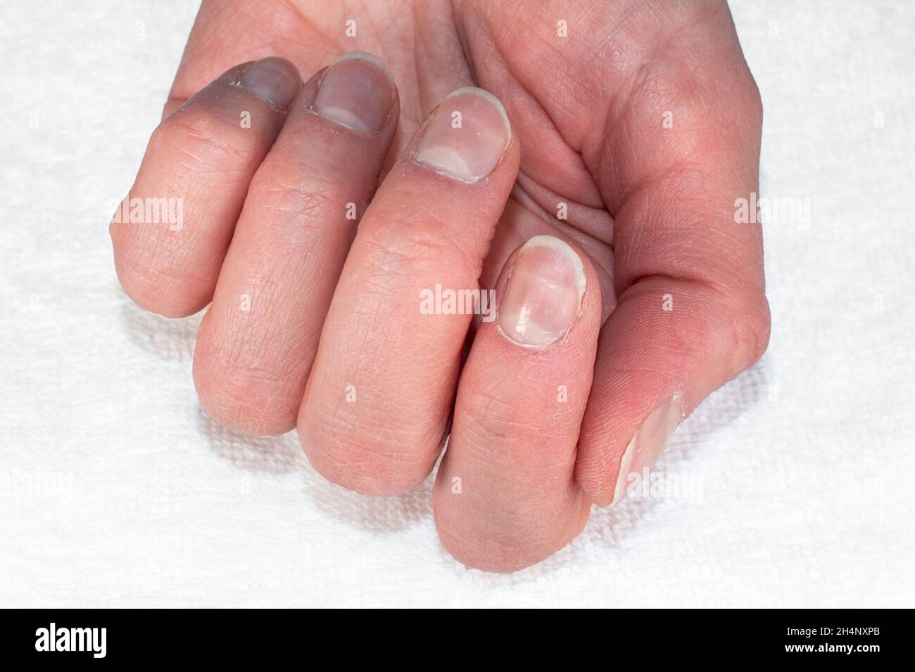Overgrown cuticle hi-res stock photography and images - Alamy