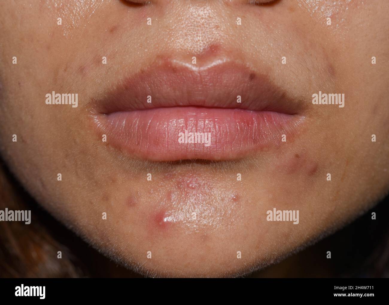 Scar lip hi-res stock photography and images - Alamy