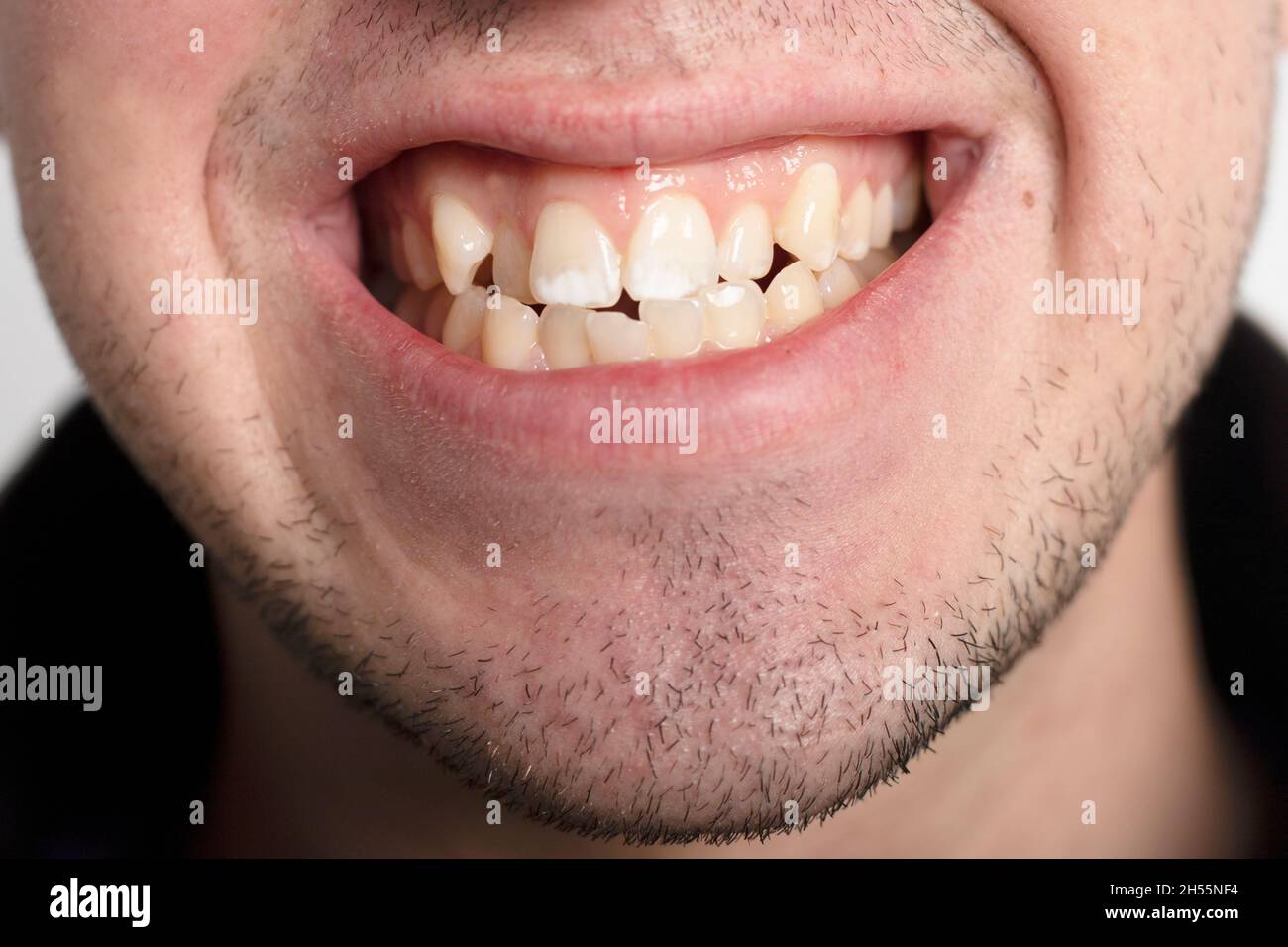 Adult teeth child mouth hi-res stock photography and images - Alamy