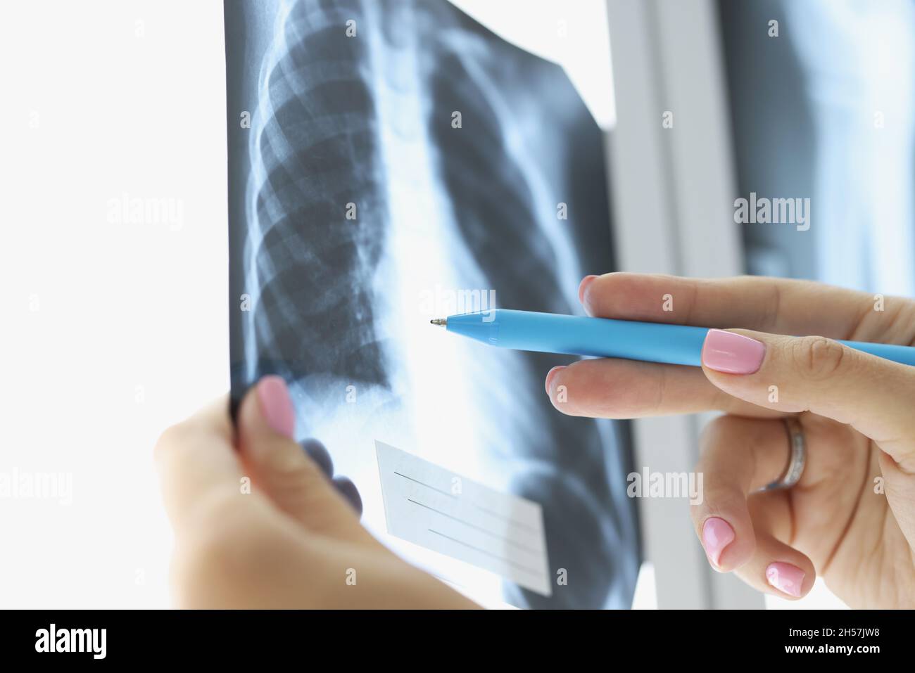 Scan of pulmonary Stock Photo - Alamy