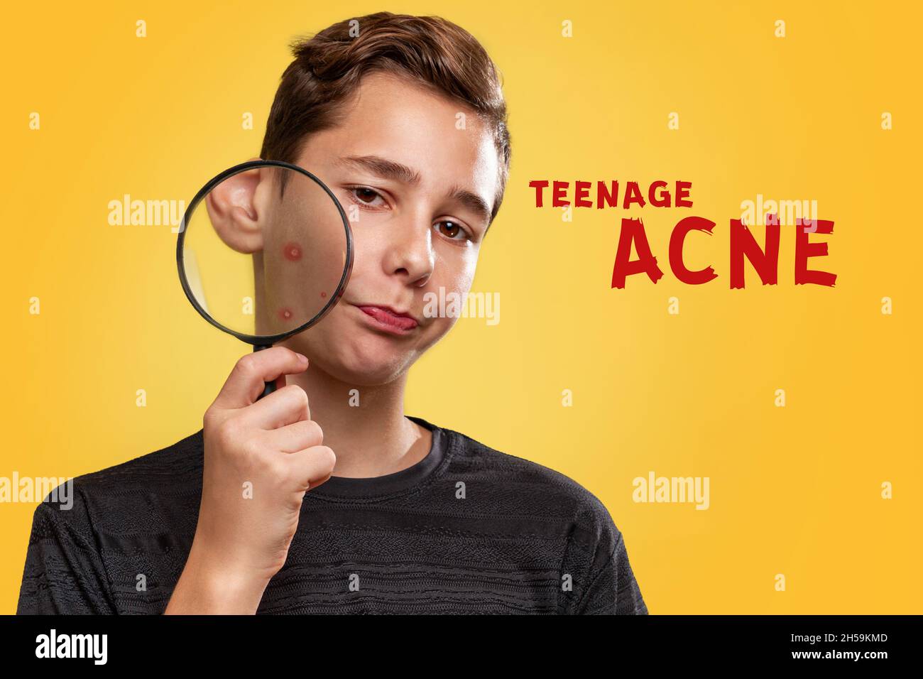 The concept of teenage acne. A teenage boy with a distressed face ...