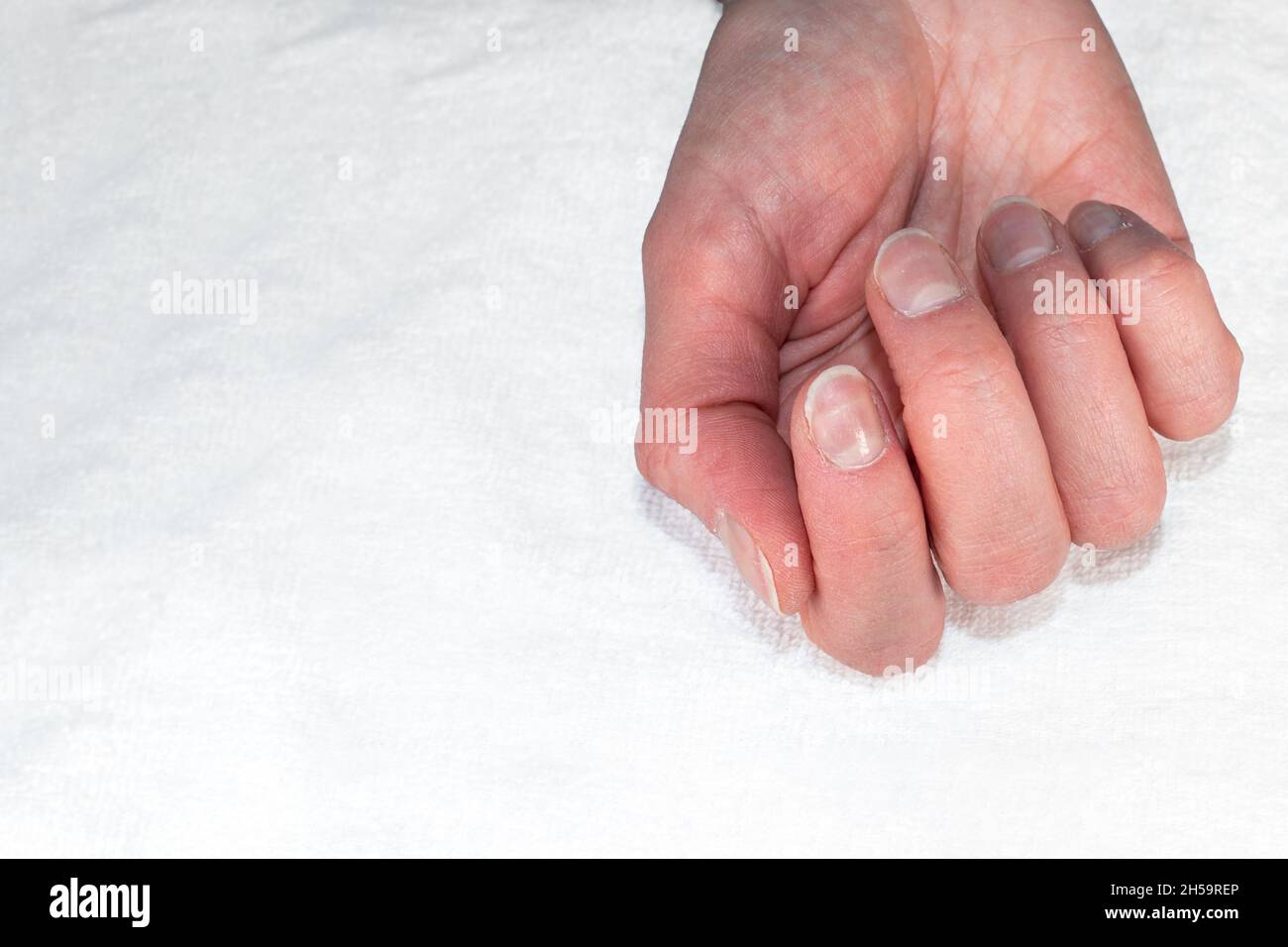 Caucasian female hand with natural unpolished nails, overgrown with ...