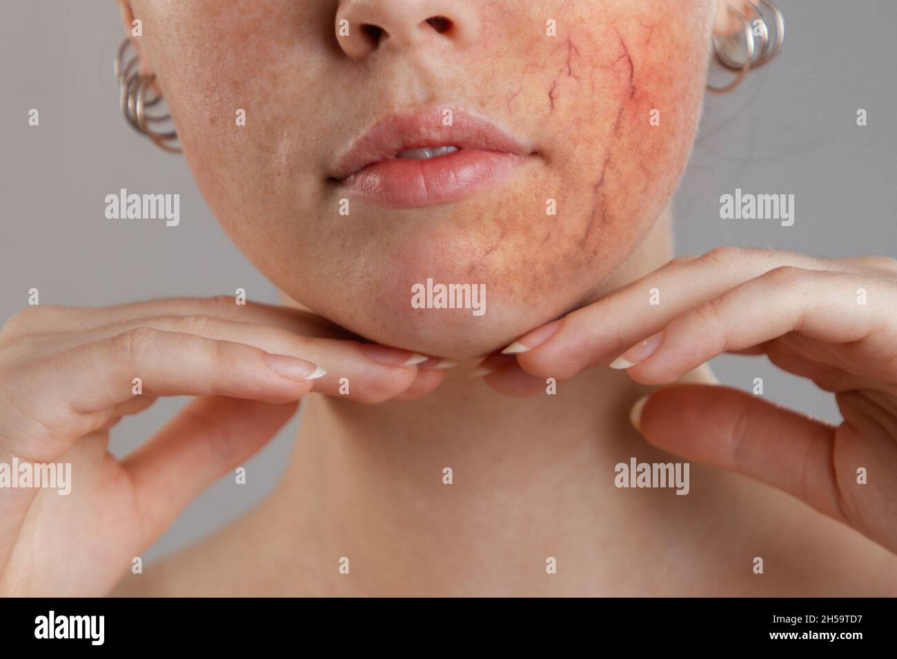 Cosmetology and rosacea. Portrait of half a woman's face. Hands at the ...