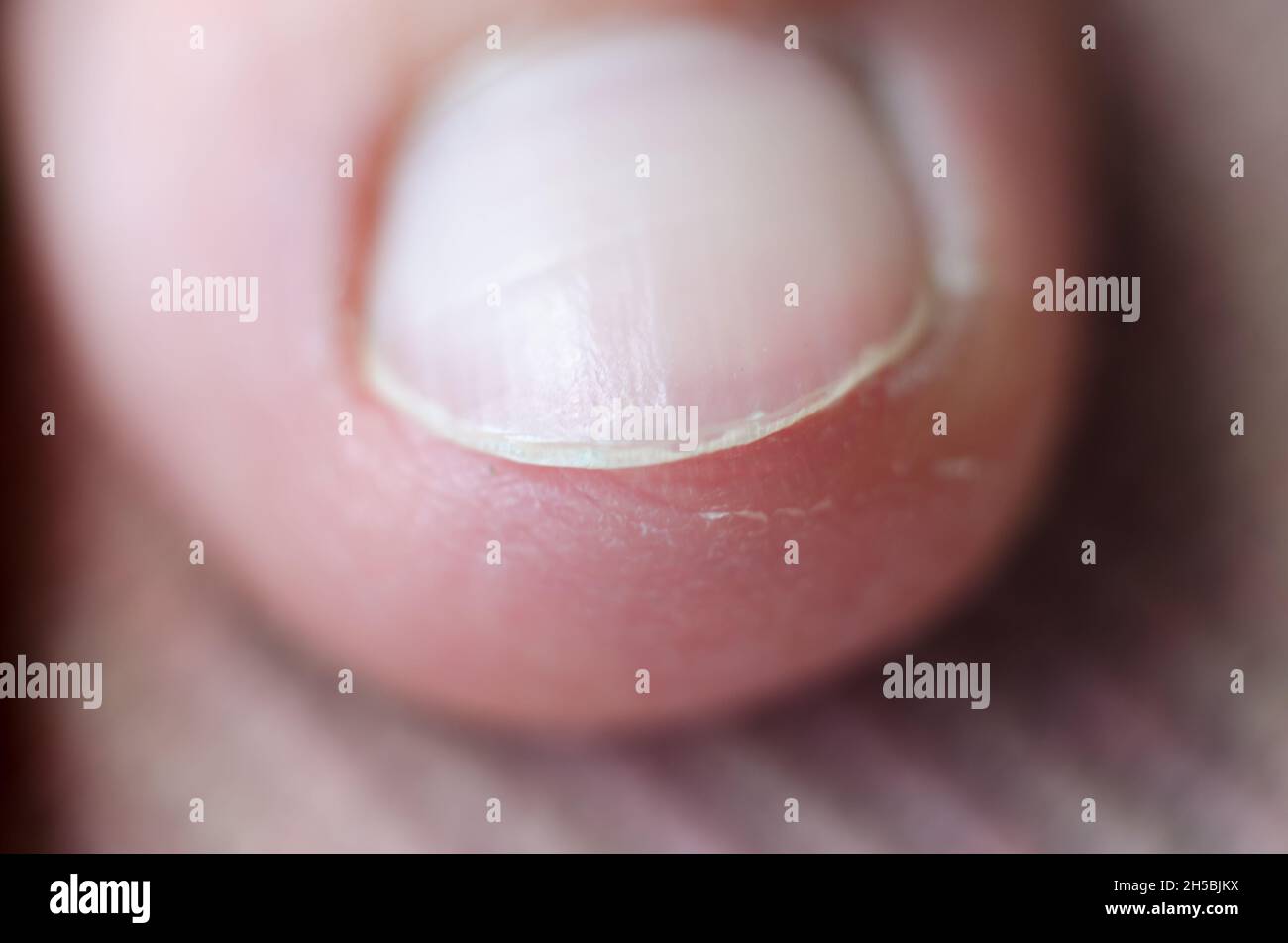Dirty toe nails hi-res stock photography and images - Alamy