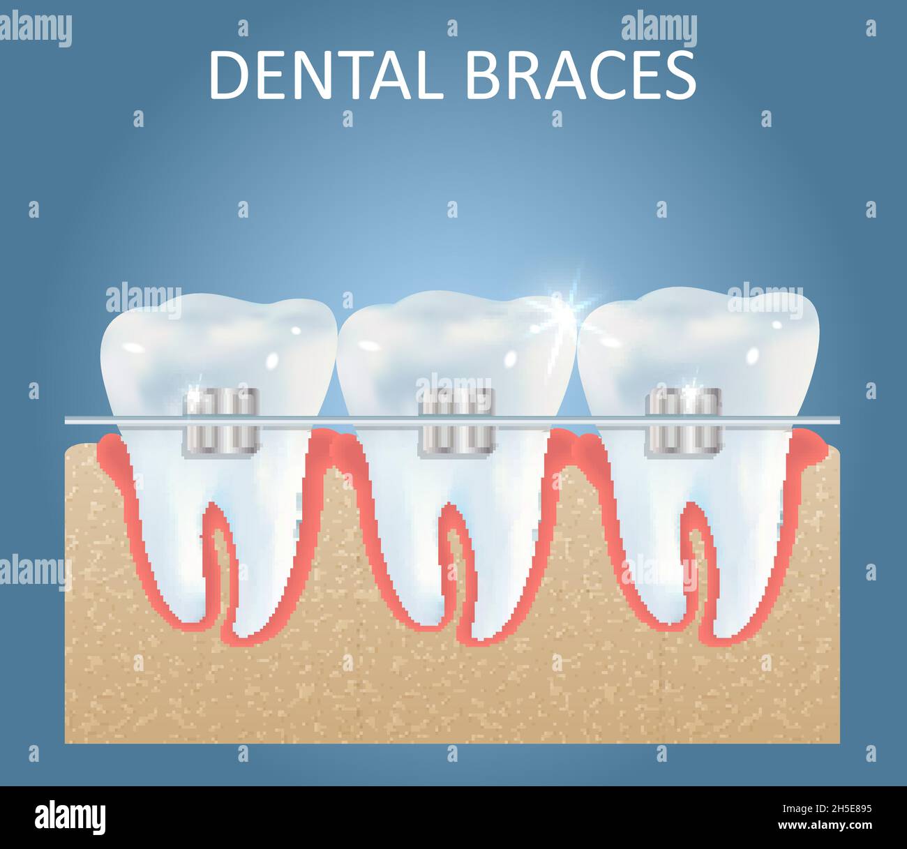 Dental braces vector medical poster design template Stock Vector Image ...