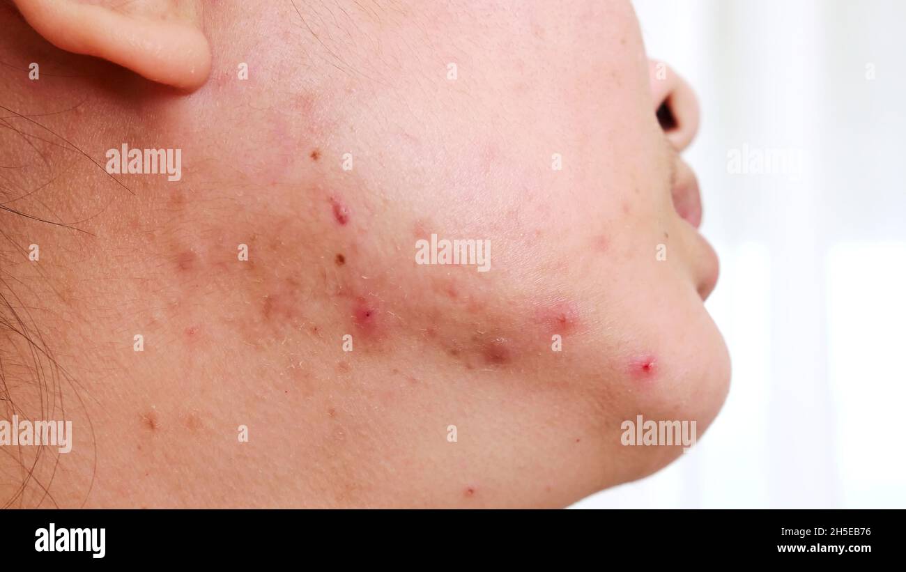 Young women with problematic skin and pimples on her face Stock Photo ...