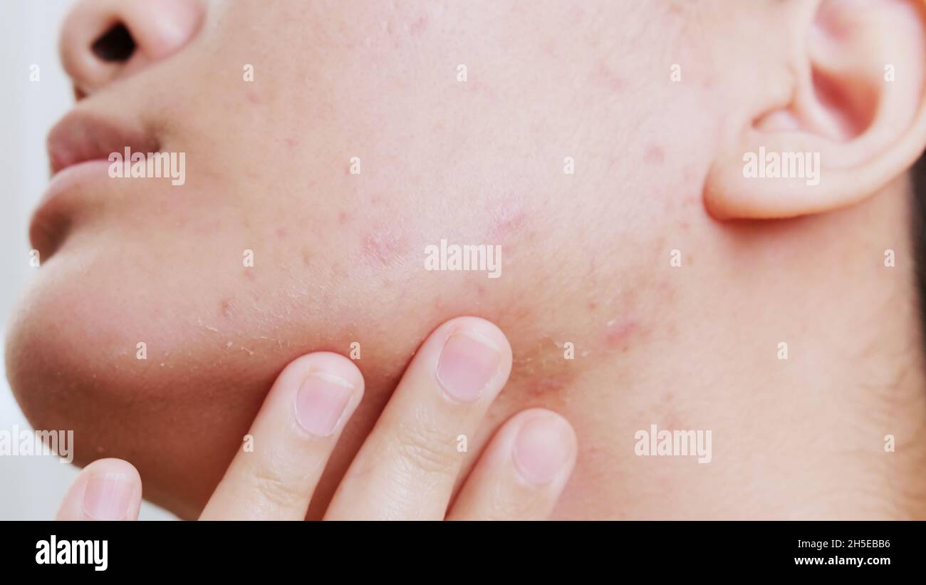 Young women with problematic skin and pimples on her face Stock Photo ...